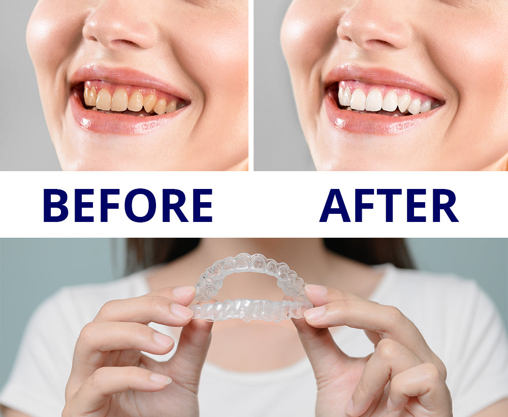 FAST ACTING 35% PREMIUM DENTAL STRENGTH TEETH WHITENING GEL